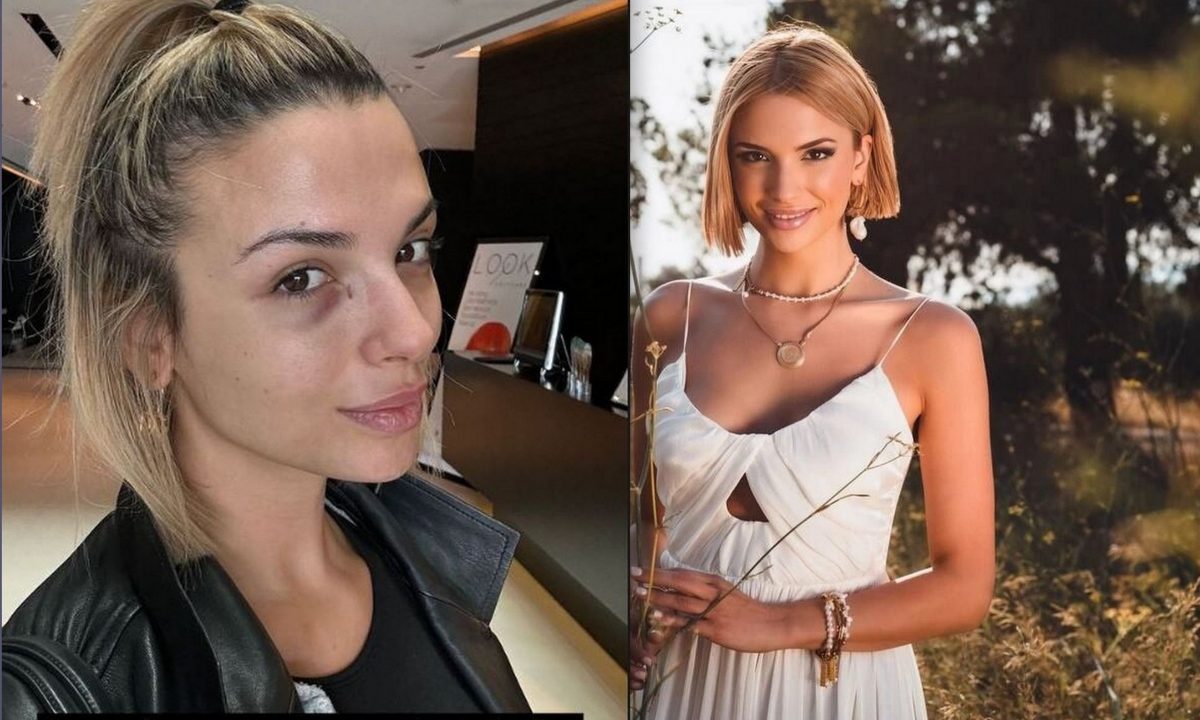 Κατερίνα Λιόλιου: Η φωτογραφία με μελανιασμένο μάτι μετά το περιστατικό ...